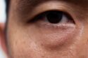 Droopy Eyelid After Botox - Causes, Solutions, and Expert Insights