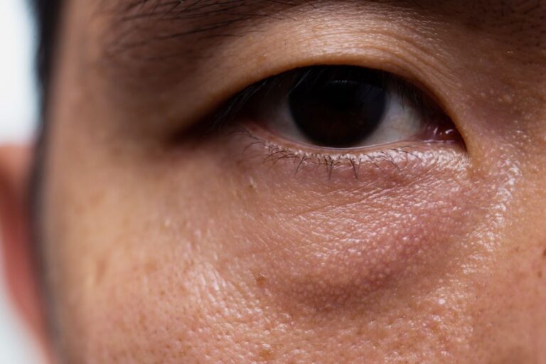 Droopy Eyelid After Botox - Causes, Solutions, and Expert Insights